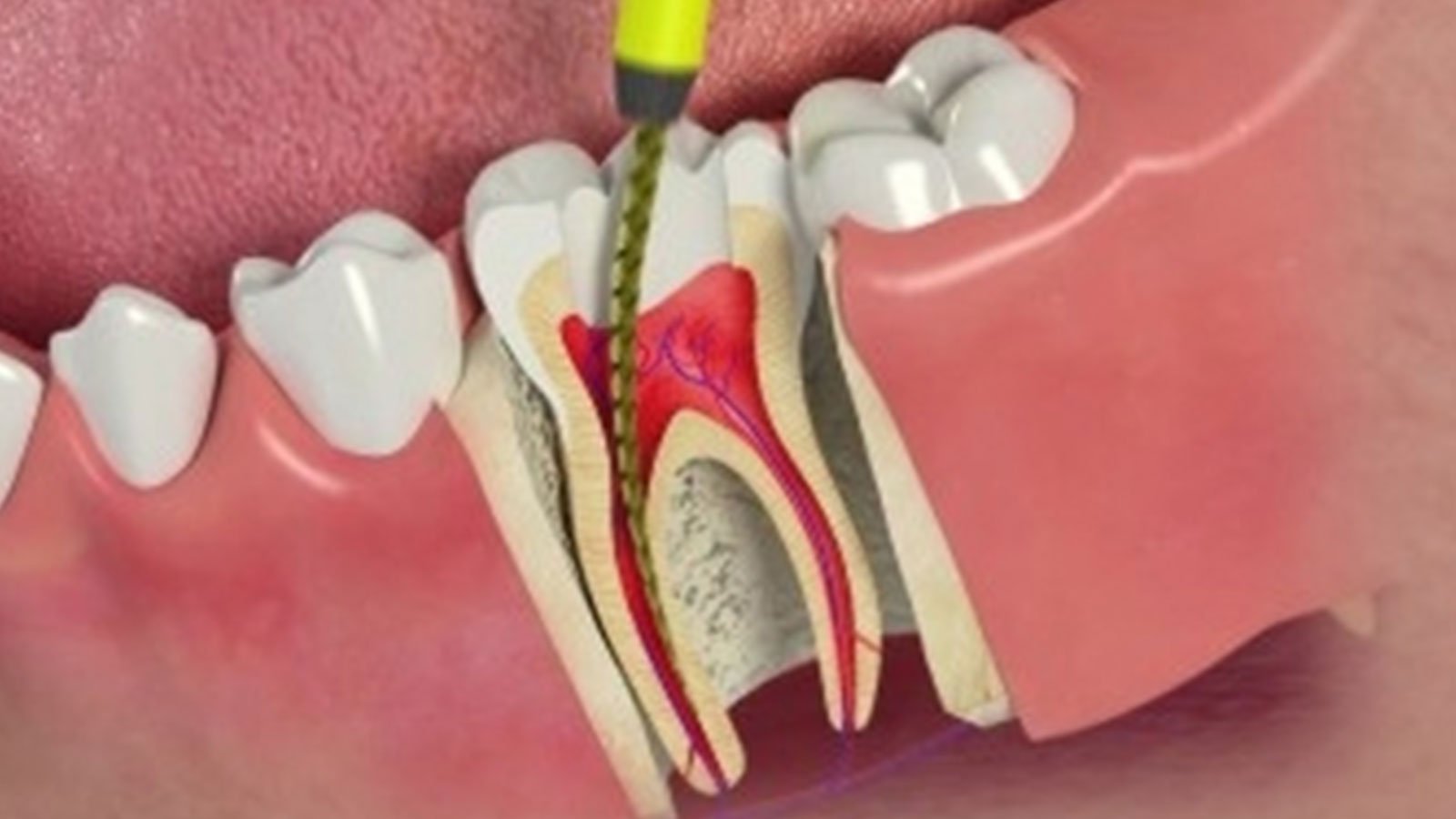 Root Canals - Tamarac Dental Denver